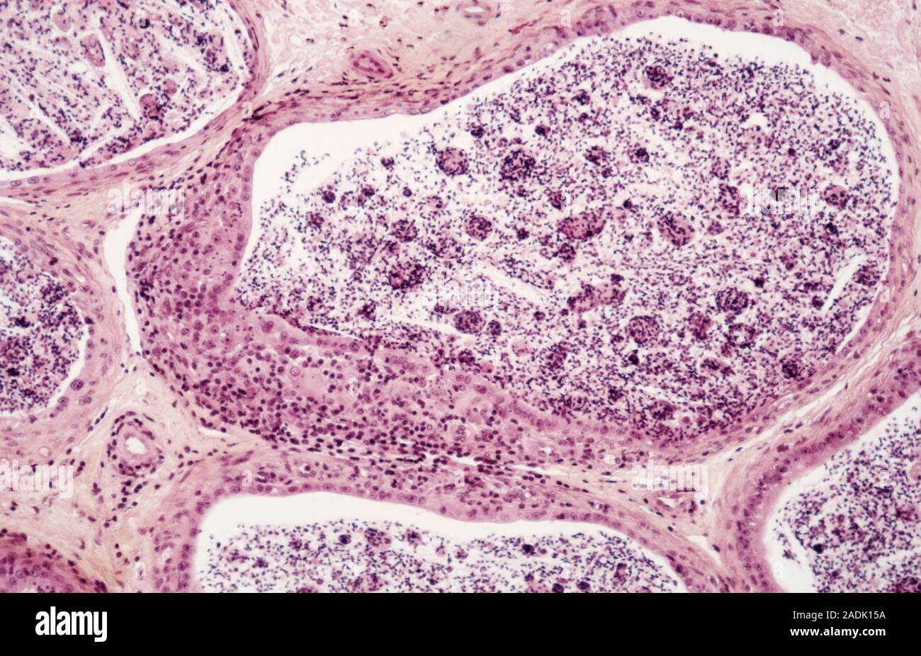 Epididymis inflammation (epididymitis). Light micrograph of a section ...