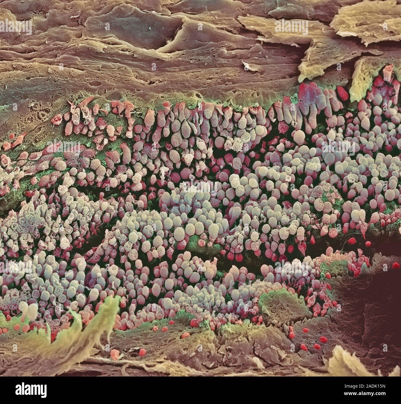 Prostate cancer. Coloured scanning electron micrograph (SEM) of tissue ...