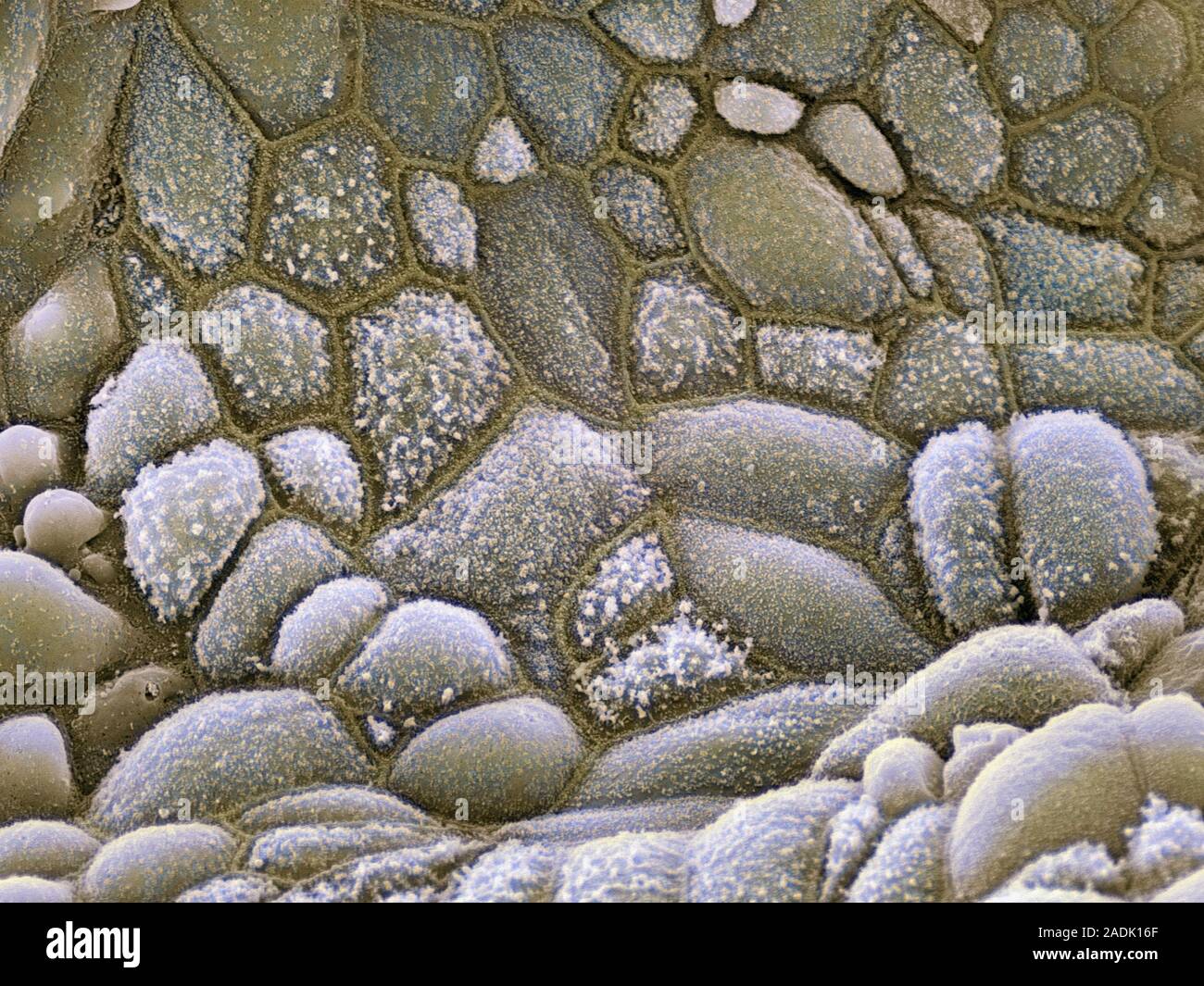 Prostate cancer. Coloured freeze-fracture scanning electron micrograph ...
