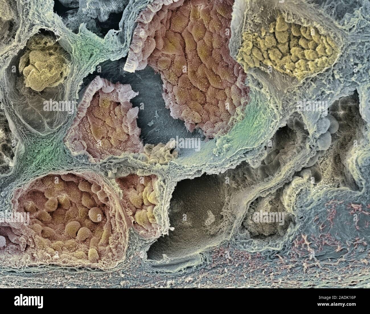 Prostate cancer. Coloured freeze-fracture scanning electron micrograph ...