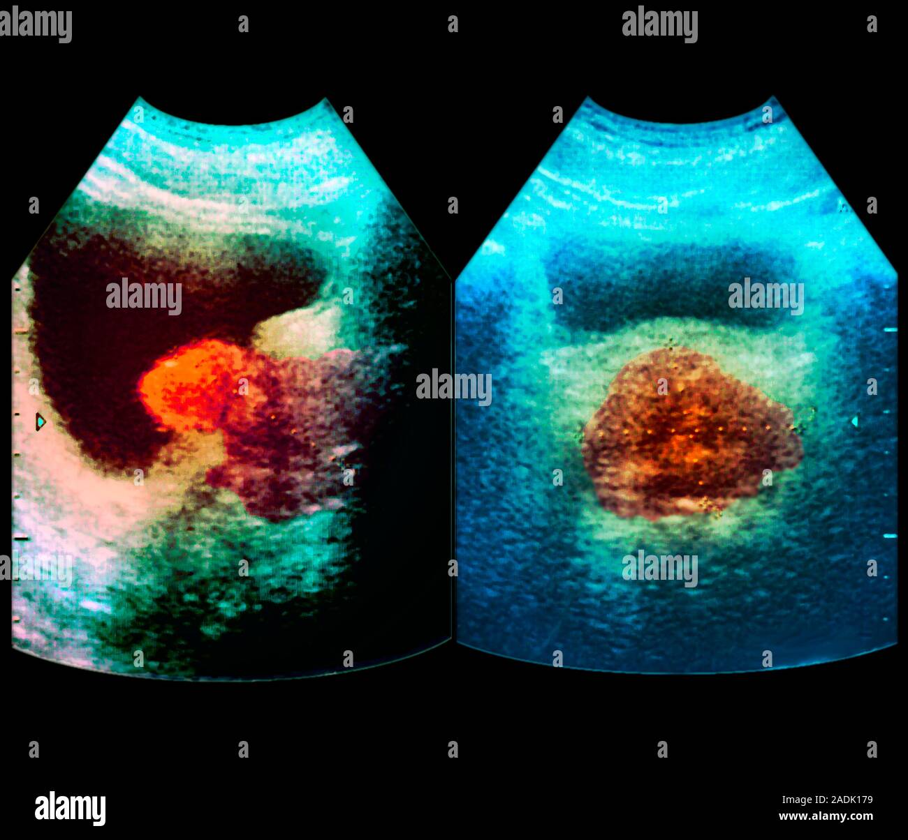 Enlarged prostate. Coloured sagittal (left) and axial (right ...