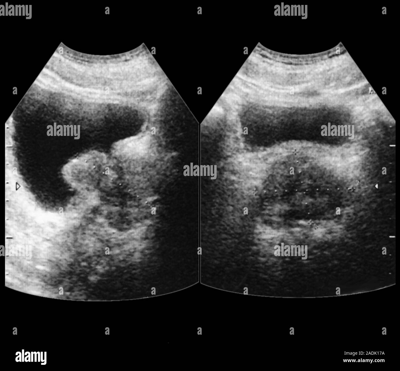 Enlarged prostate. Sagittal (left) and axial (right) ultrasound scans ...