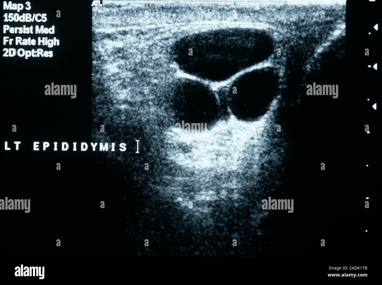 Epididymal cysts. Ultrasound scan of epididymal cysts (three black ...