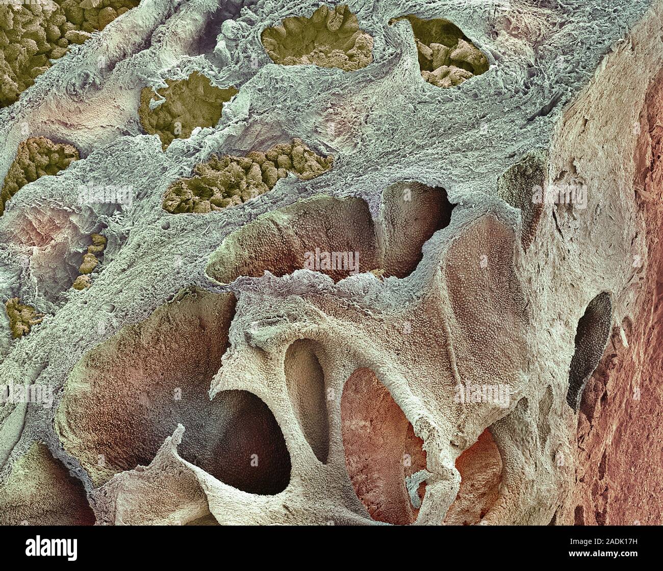 Prostate cancer. Coloured freeze-fracture scanning electron micrograph ...