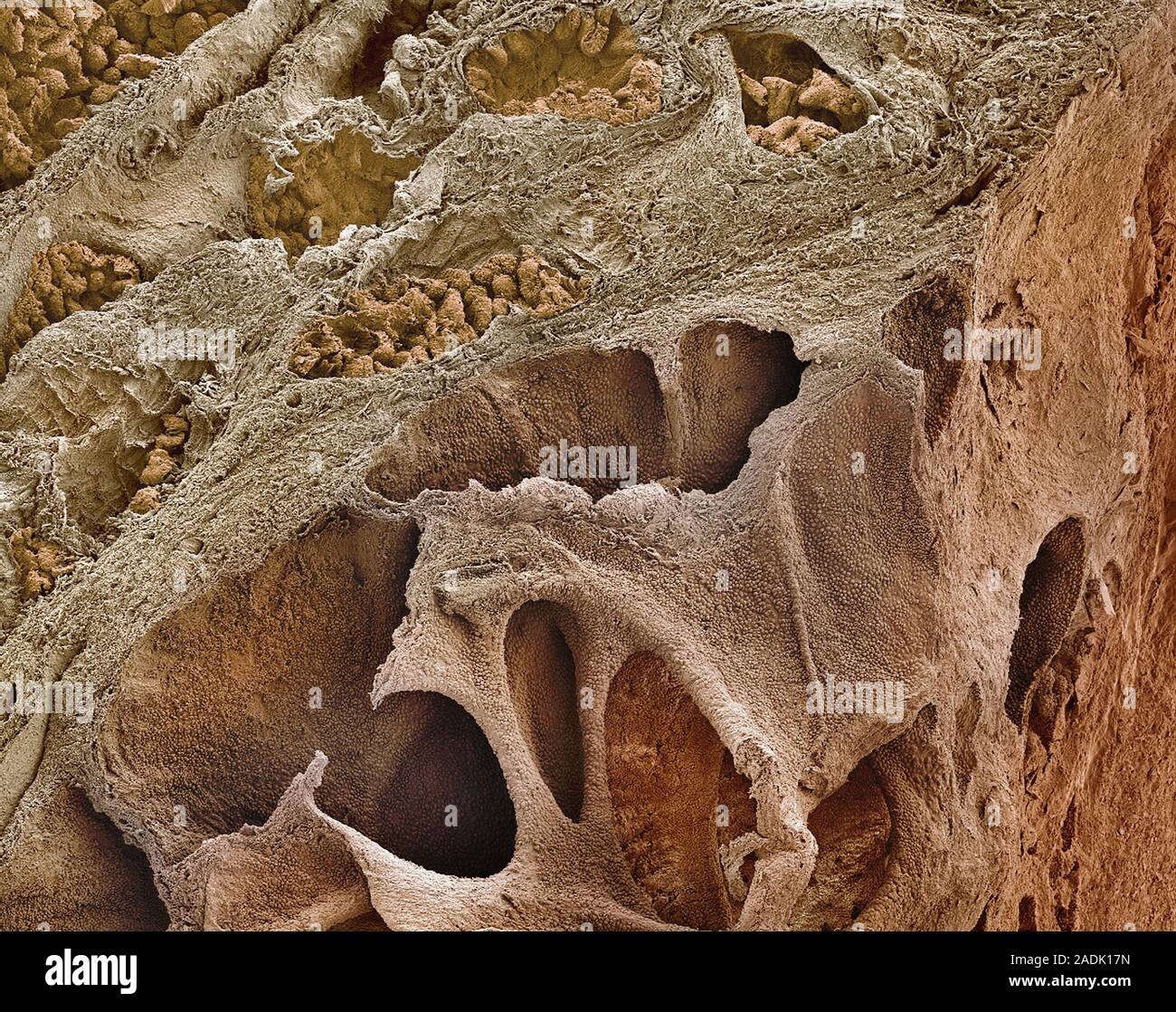 Prostate cancer. Coloured freeze-fracture scanning electron micrograph ...