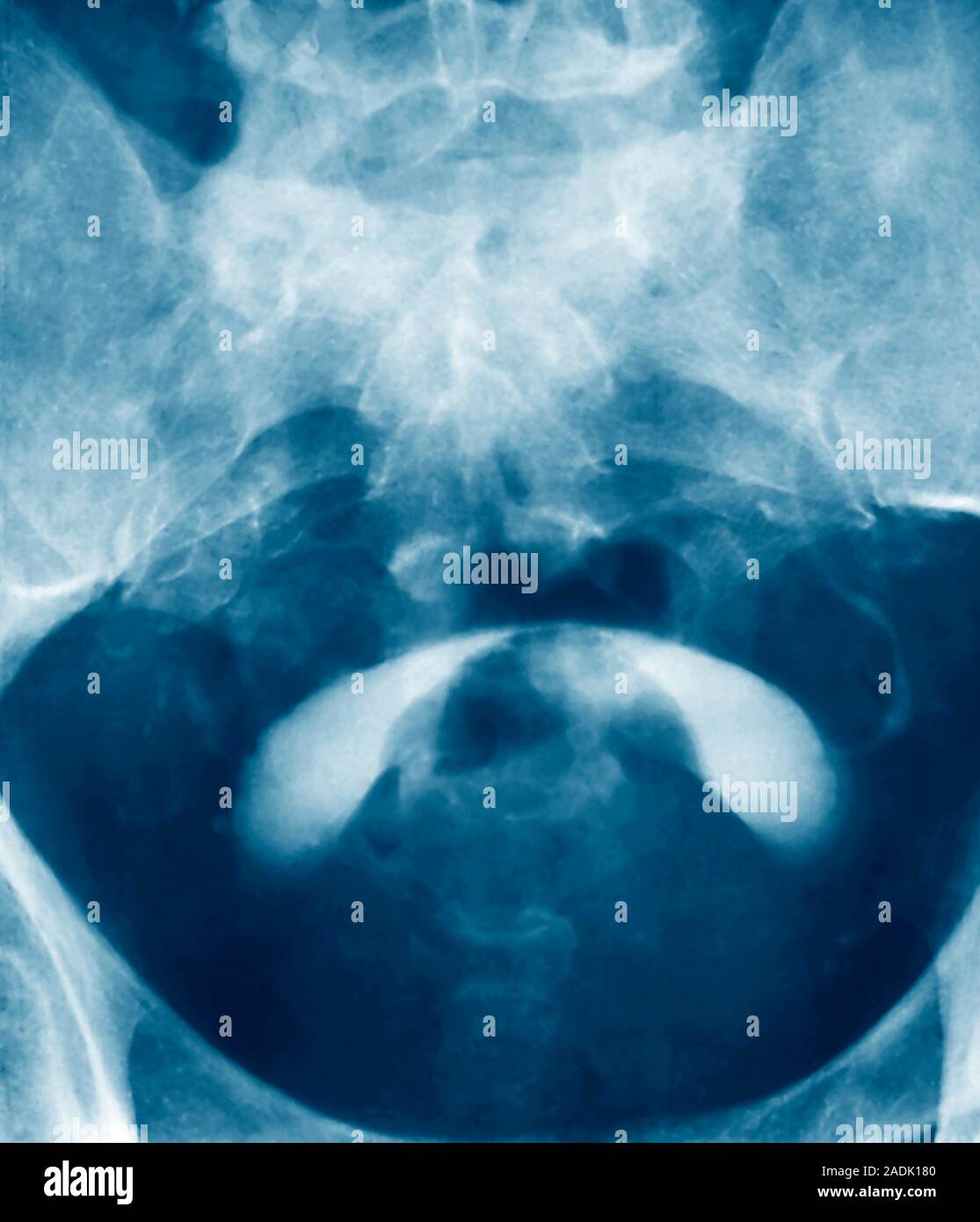 Prostate tumour. Urogram (X-ray) of the pelvis of a 60 year old man ...