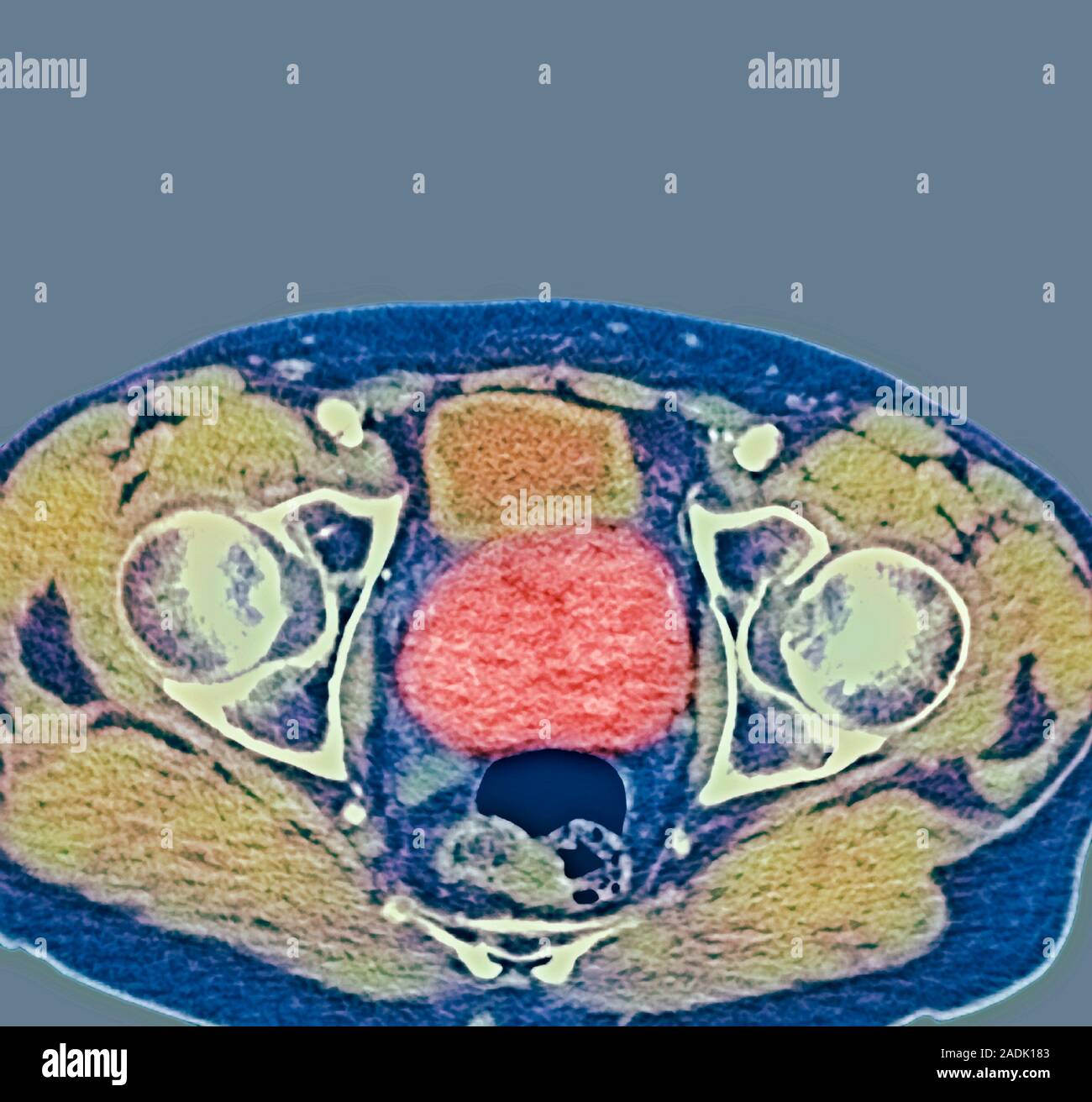 Prostate cancer. Axial coloured magnetic resonance imaging (MRI) scan ...