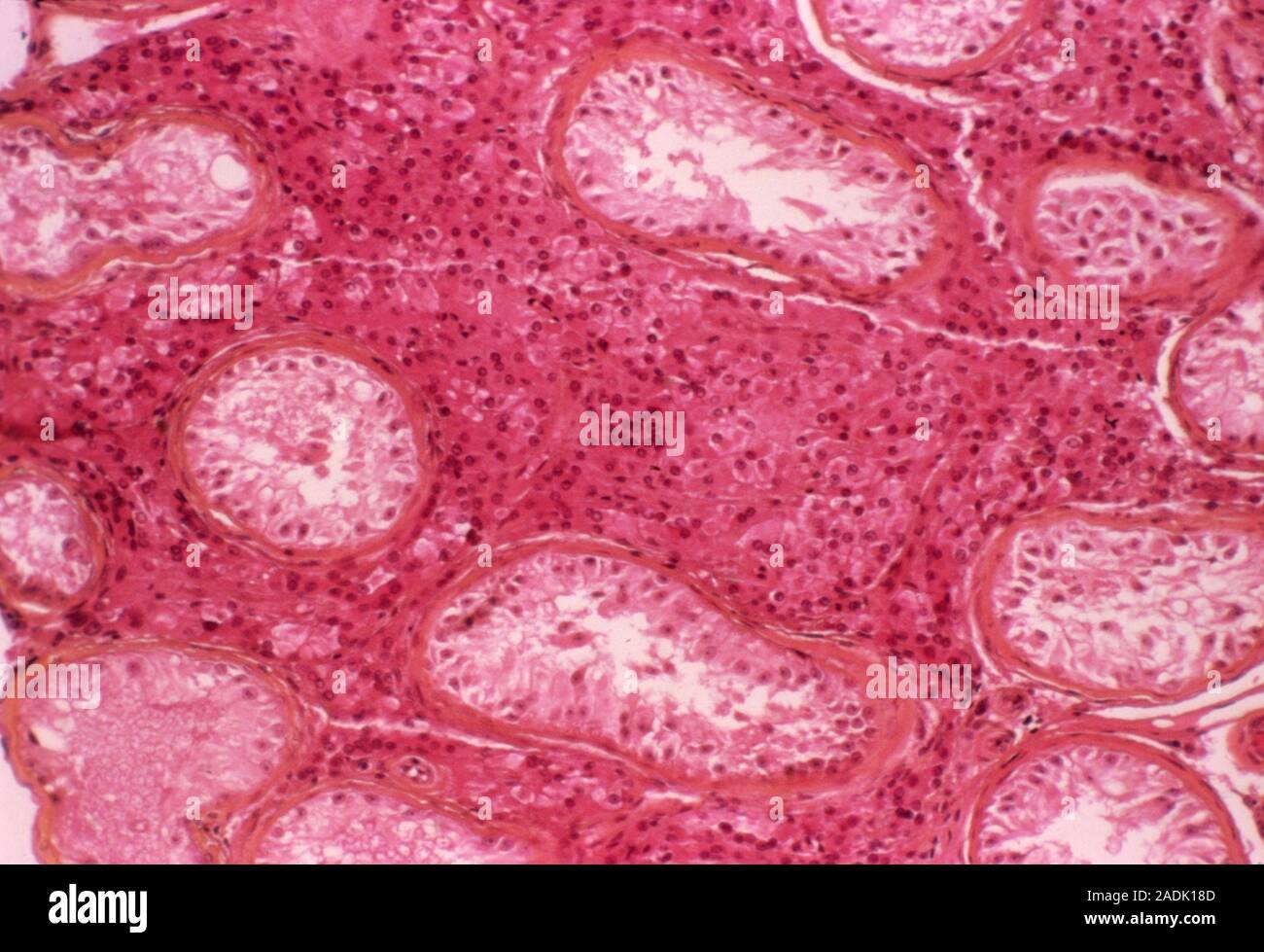 Abnormal testicle. Light micrograph of tissue from an ectopic testicle ...