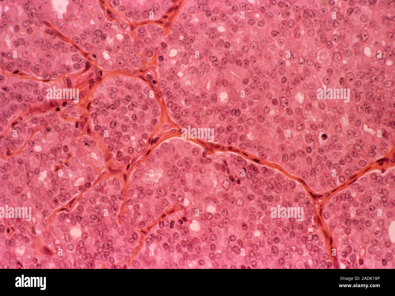 Prostate cancer. Light micrograph of a section through a prostate gland ...