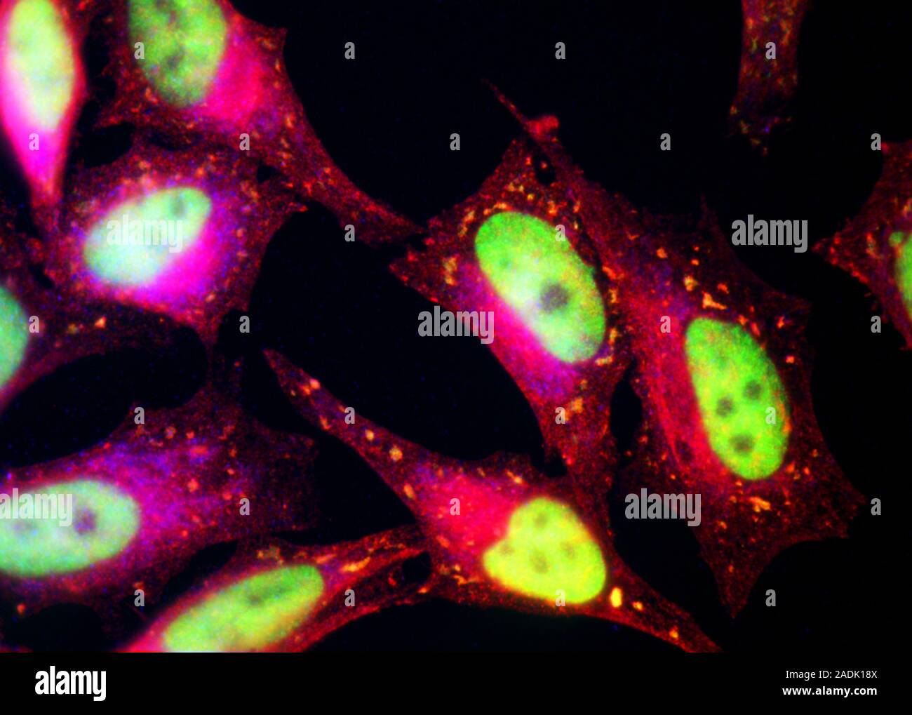 Prostate cancer cells, confocal light micrograph. The cells' nuclei are ...