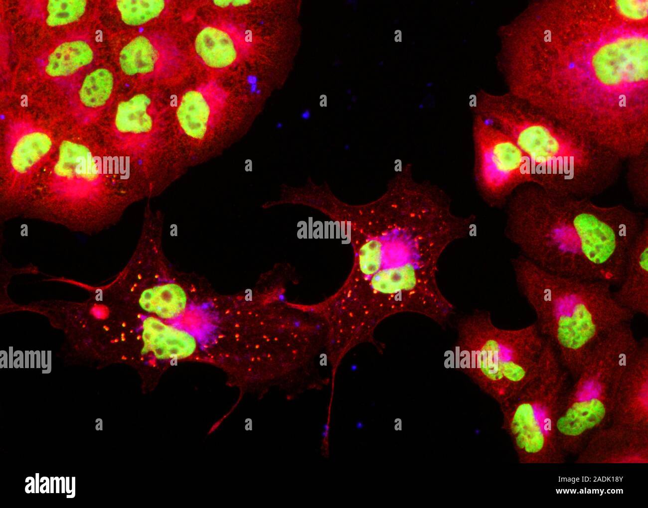 Prostate cancer cells, confocal light micrograph. The cells' nuclei are ...