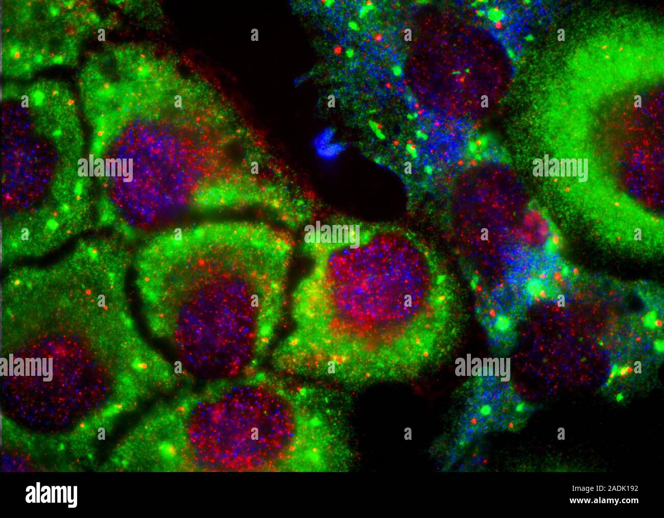 Prostate cancer cells, confocal light micrograph. Stress granules ...