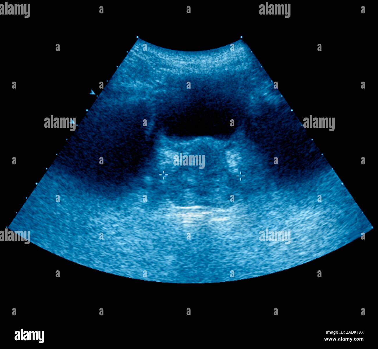 Prostate tumour. Coloured ultrasound scan of a section through the ...