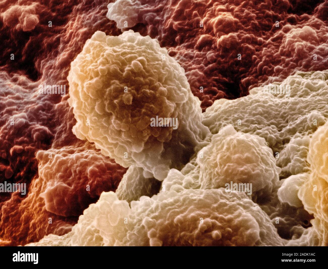 Prostate cancer cells, coloured scanning electron micrograph (SEM). The ...