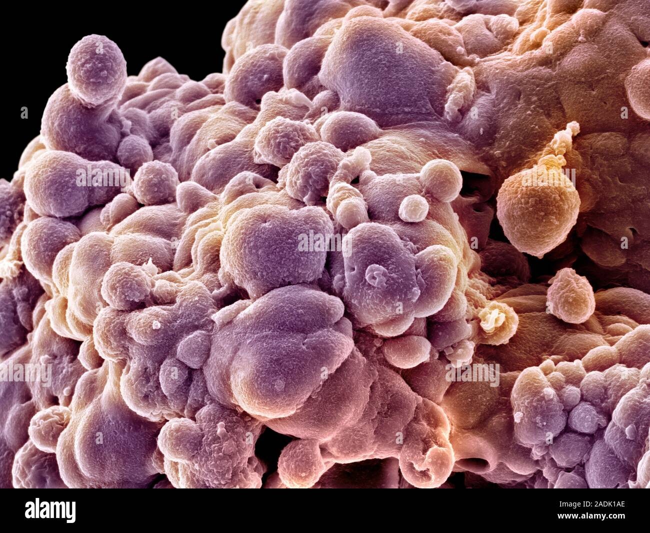 Prostate cancer cells, coloured scanning electron micrograph (SEM). The ...