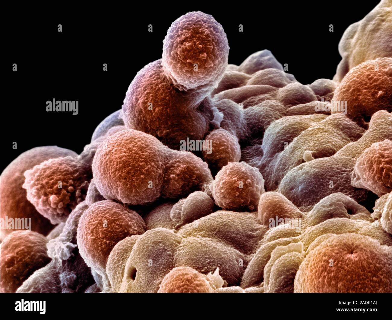 Prostate cancer cells, coloured scanning electron micrograph (SEM). The ...