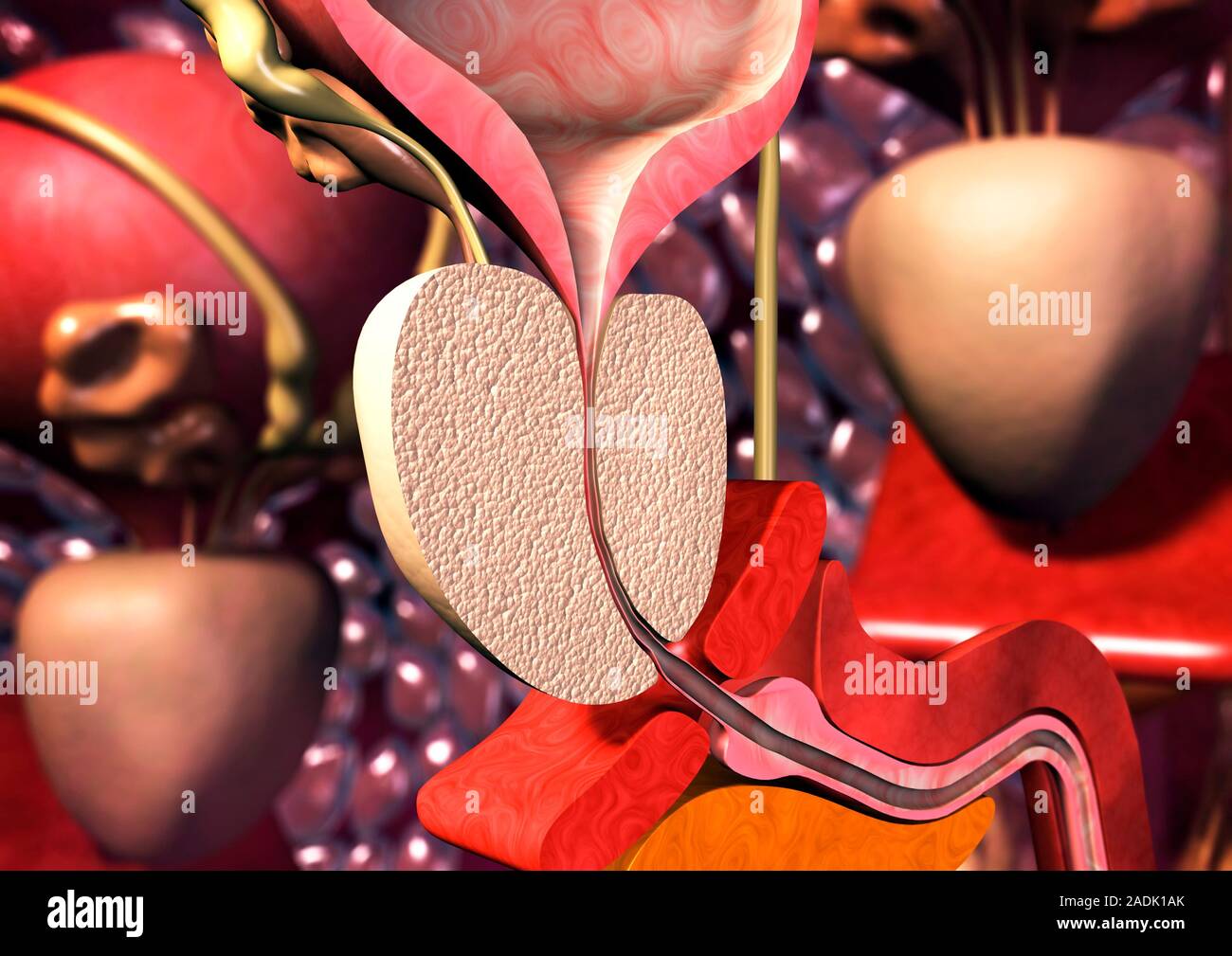 Enlarged prostate. Computer artwork of a section through an enlarged ...