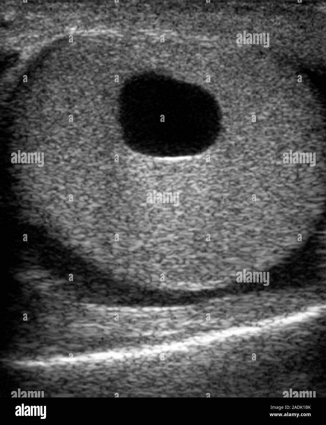 Testicular Tumour Ultrasound Scan Of A Patient With A Cyst Black Circle On His Testicle