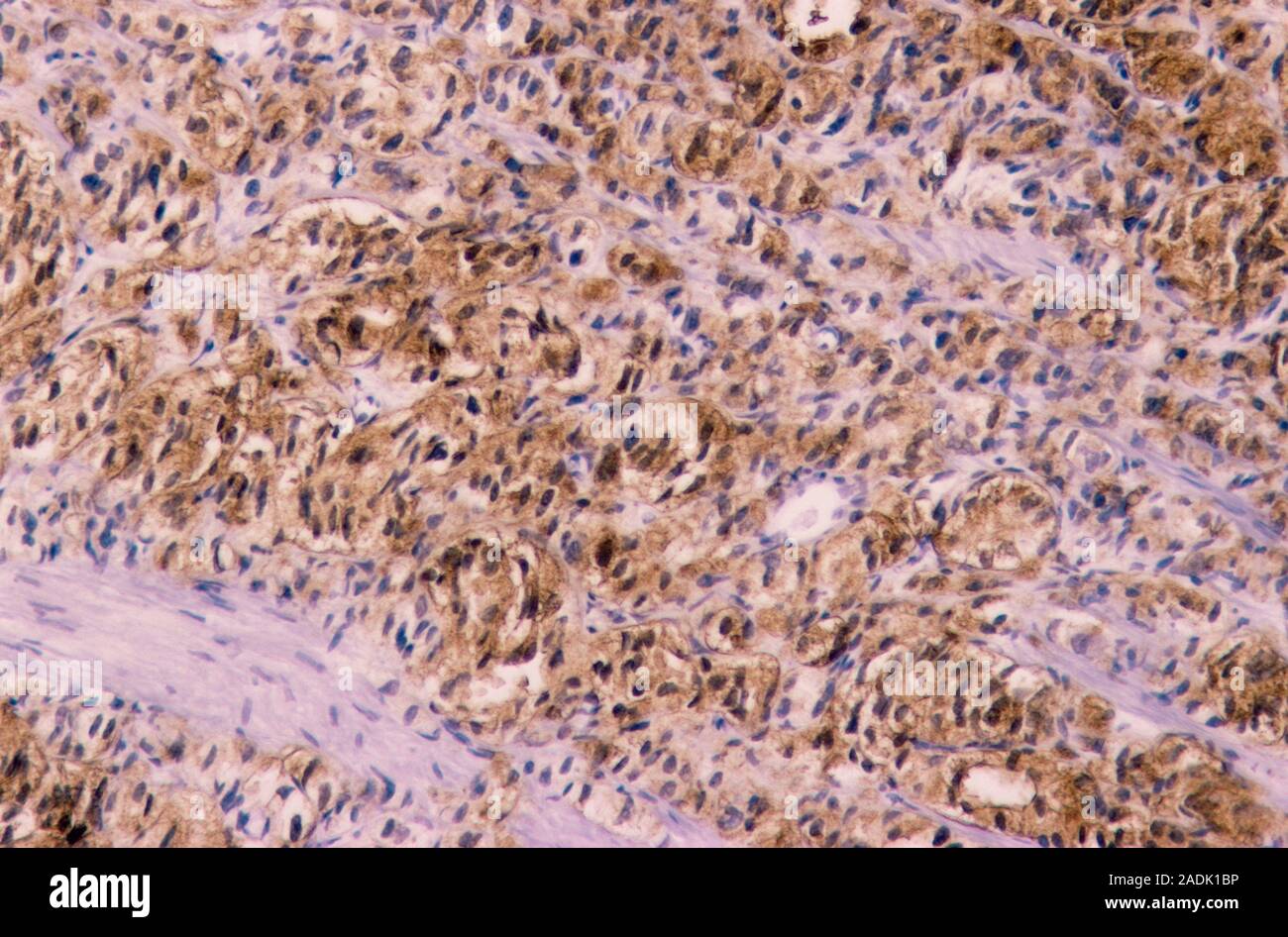 Prostate cancer. Light micrograph of a section through a prostate gland ...