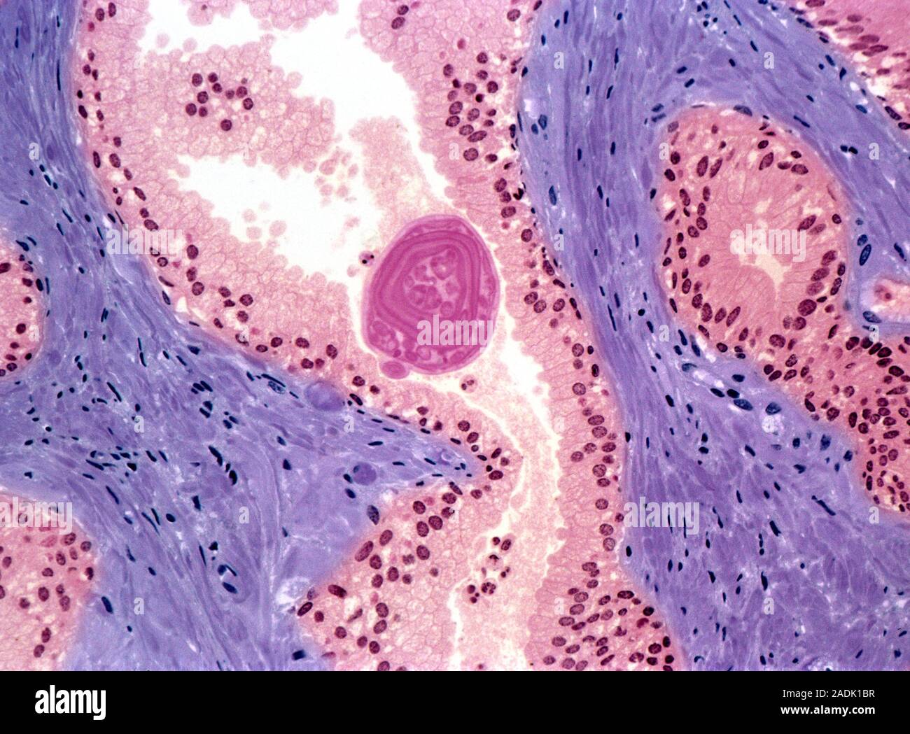 Prostate hyperplasia. Coloured light micrograph of a section through a ...