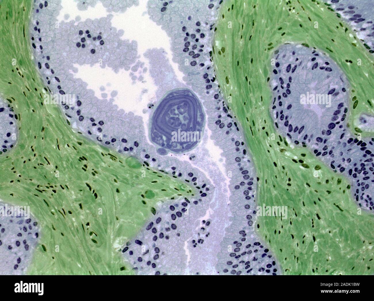 Prostate hyperplasia. Coloured light micrograph of a section through a ...