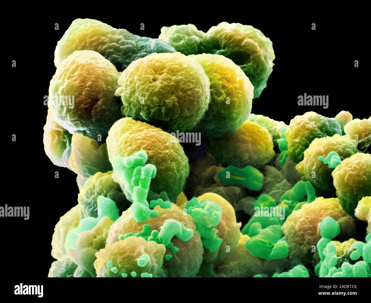 Prostate cancer cells, coloured scanning electron micrograph (SEM). The ...