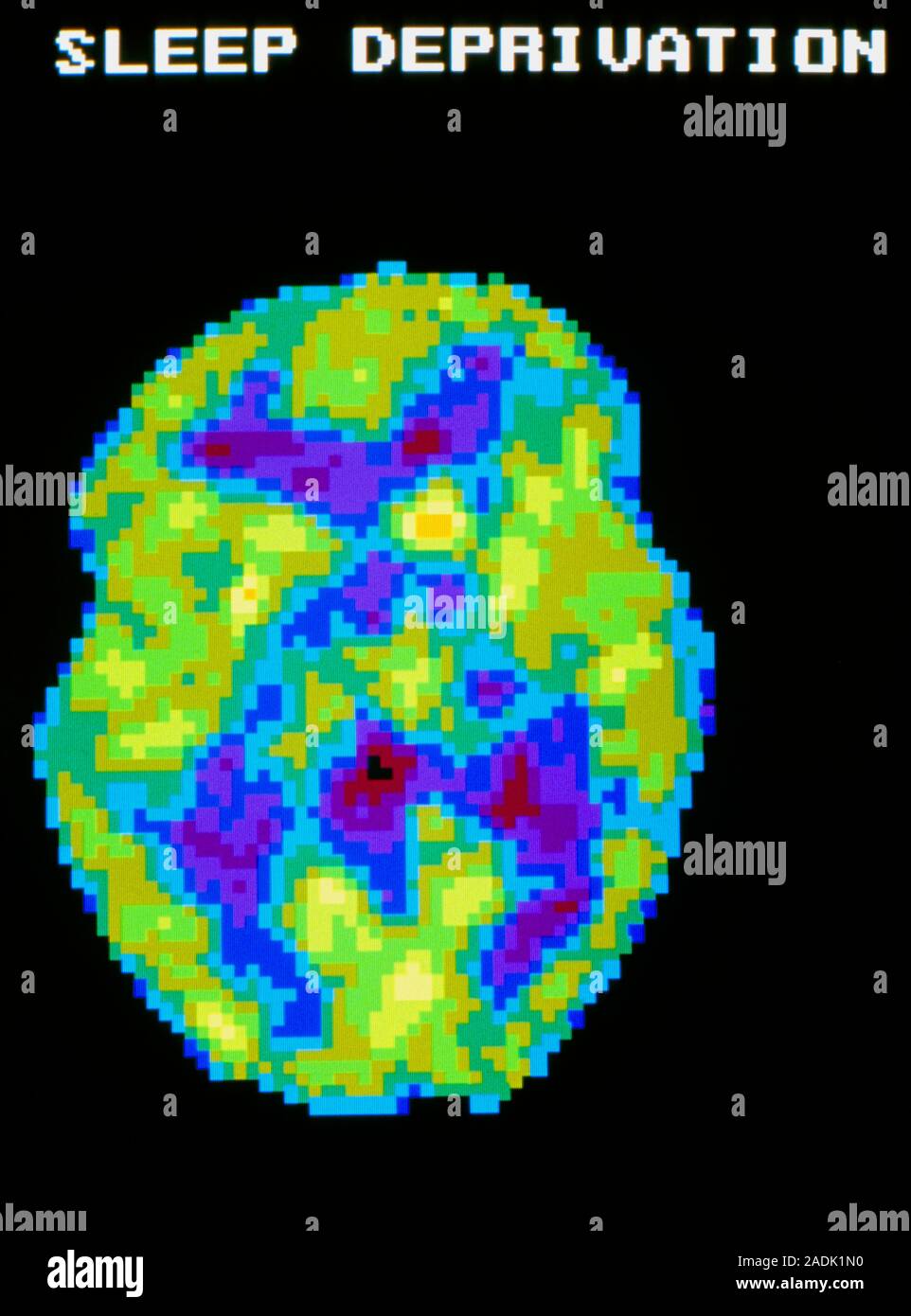 Brain during sleep deprivation. Coloured Positron Emission Tomography ...