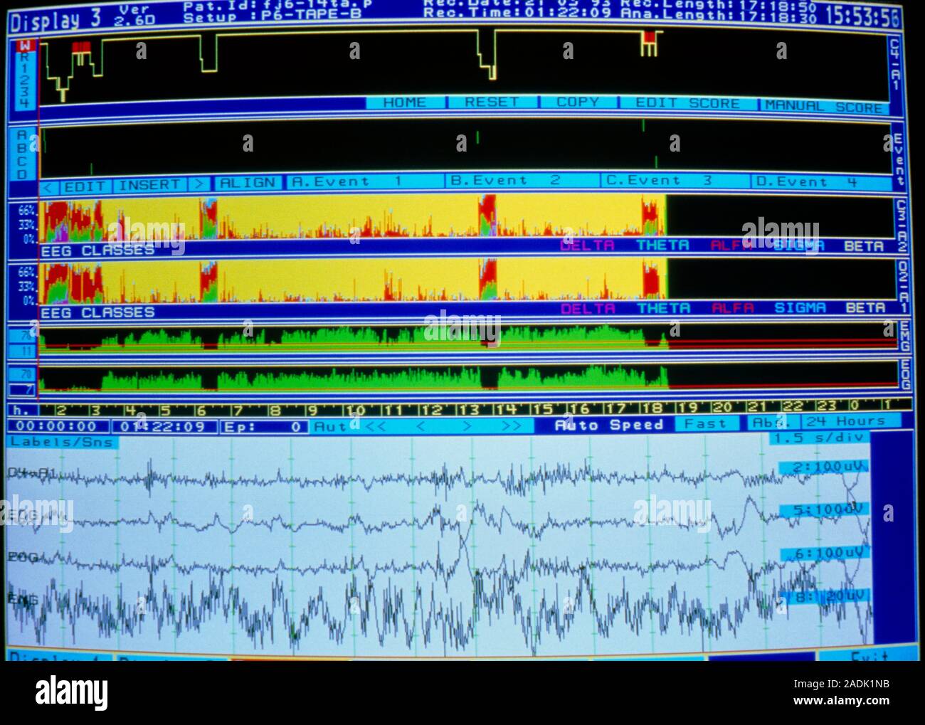 Circadian rhythm monitoring. Computer display showing a patient's ...
