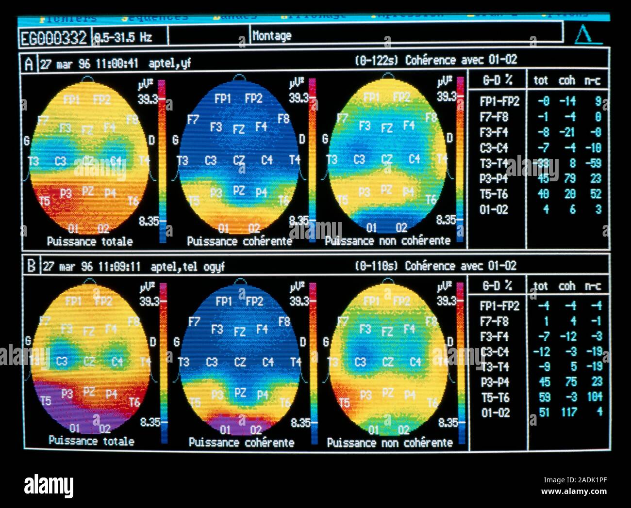 Mobile telephone research. Electroencephalogram (EEG) maps of a person ...