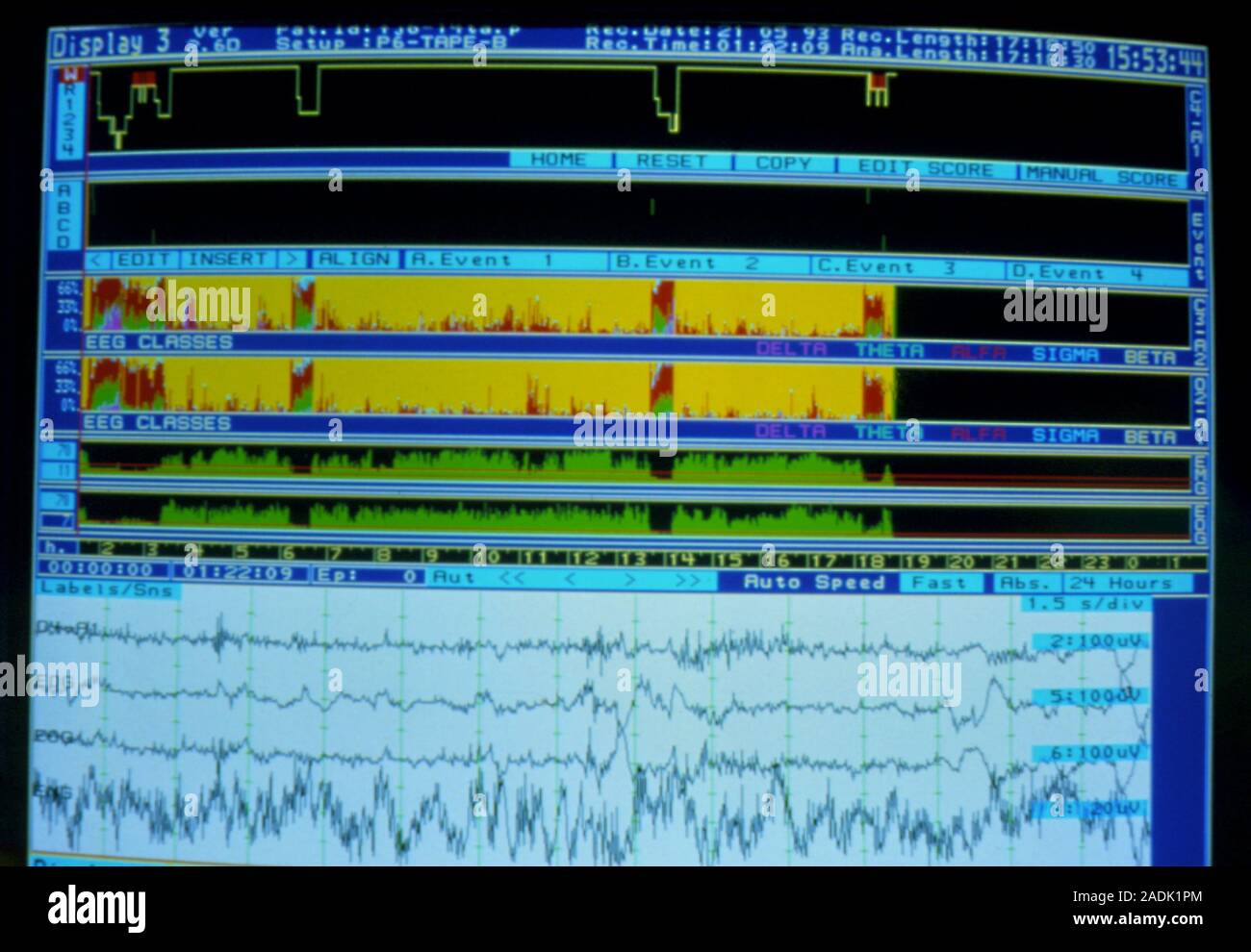 Circadian rhythm monitoring. Computer display showing a subject's ...