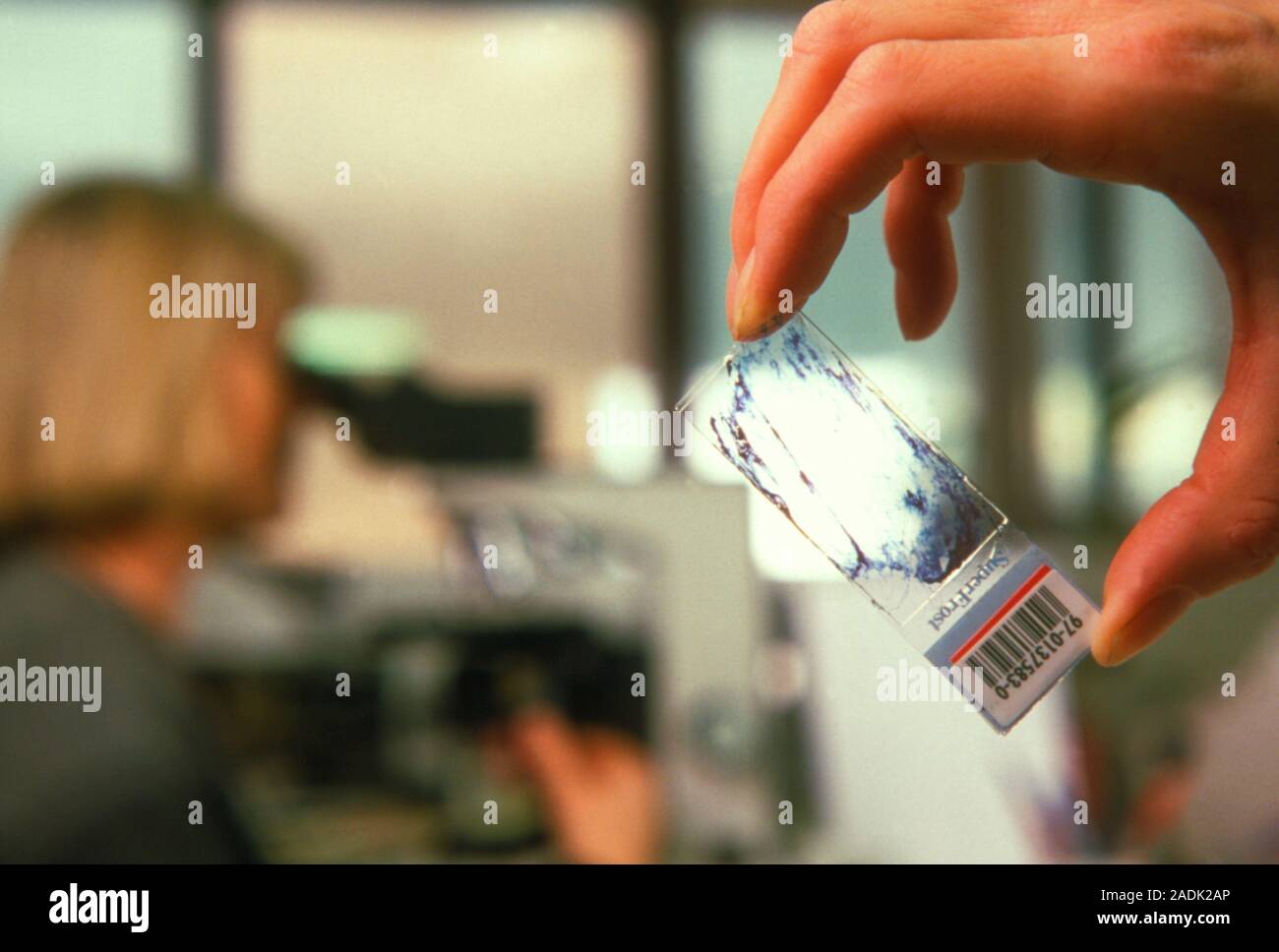 Cervical smear slide. Hand holding a stained cervical smear slide which ...