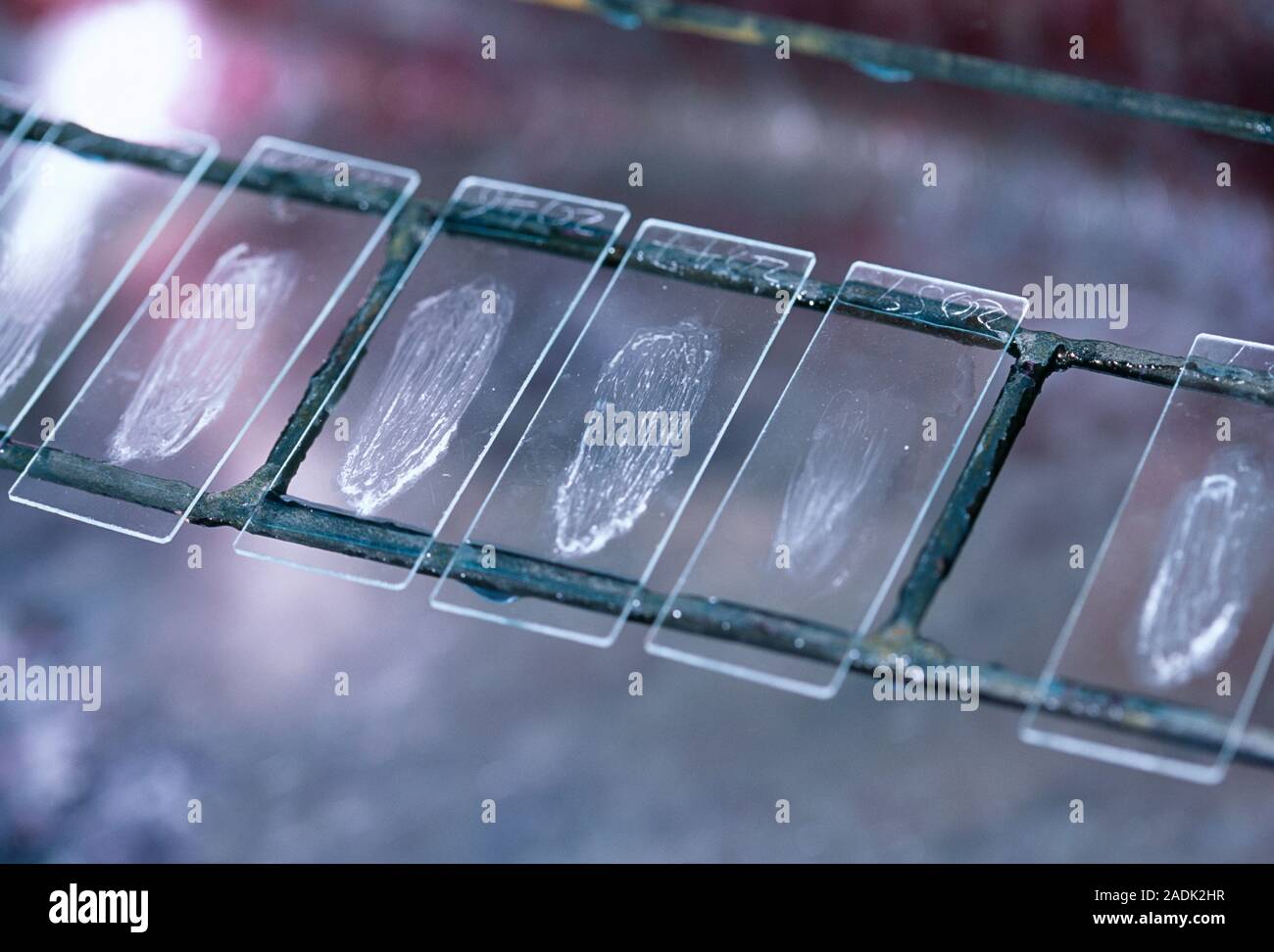 Tuberculosis diagnosis. Sputum (fluid coughed up from the lungs ...