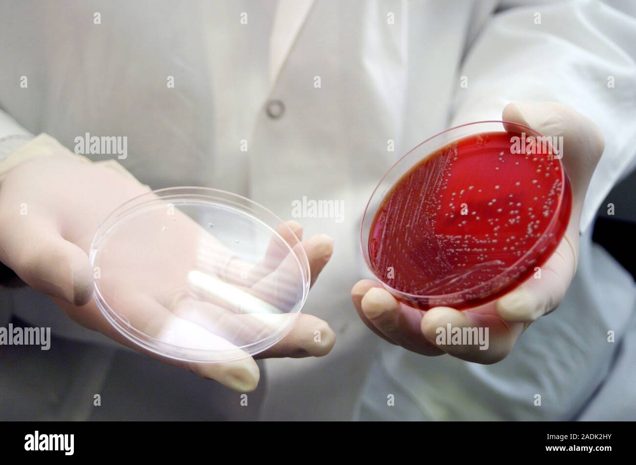Staphylococcus aureus culture. Laboratory technician holding a petri ...