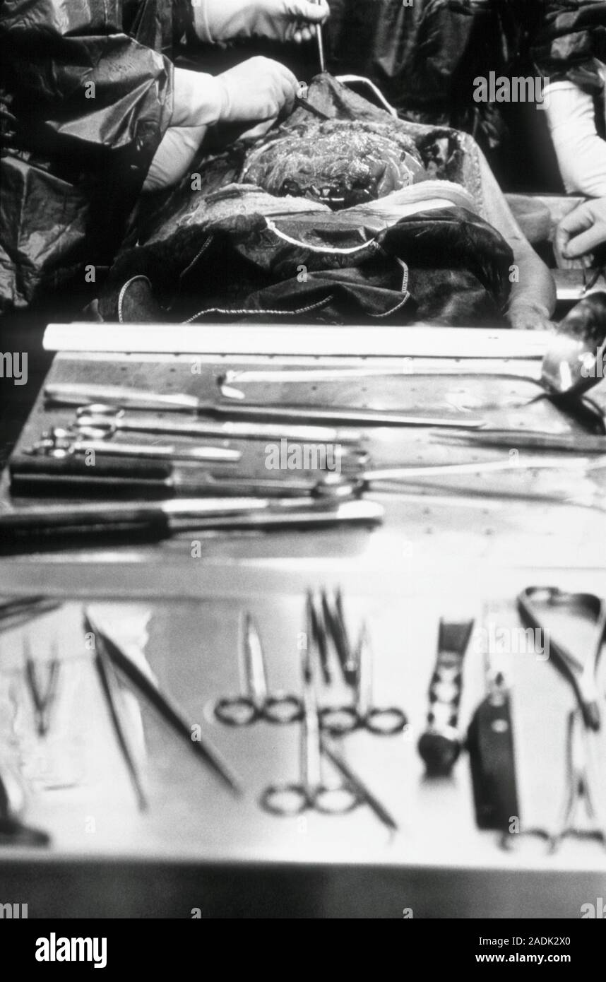 Autopsy examination. Opened corpse of a 20 year old woman being studied ...