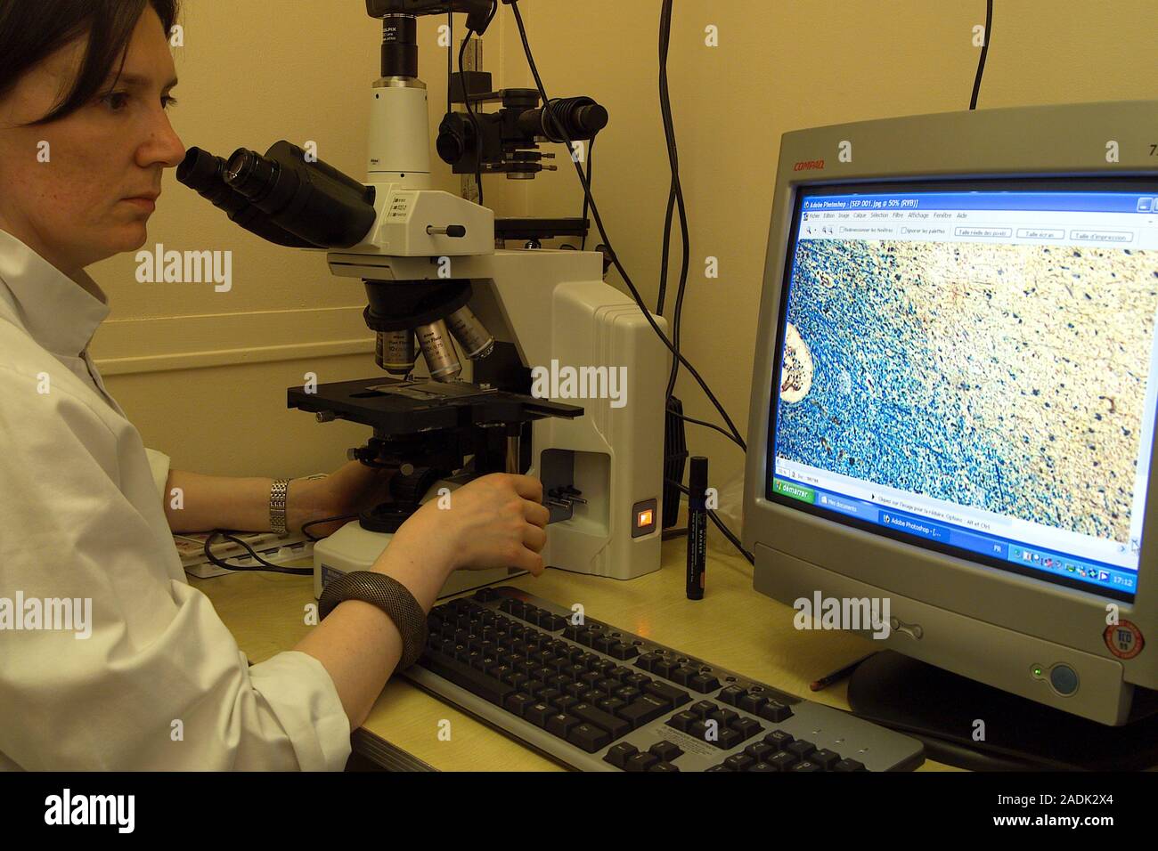 Brain pathology. Pathologist using a light microscope to study the ...