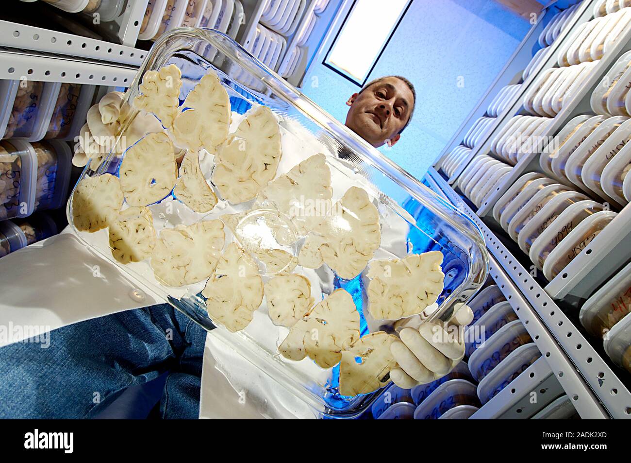 Human brain slices being carried by a technician. The brain has been ...