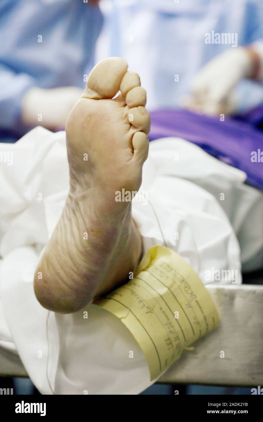 MODEL RELEASED. Foot of a corpse in a mortuary. This corpse is ...
