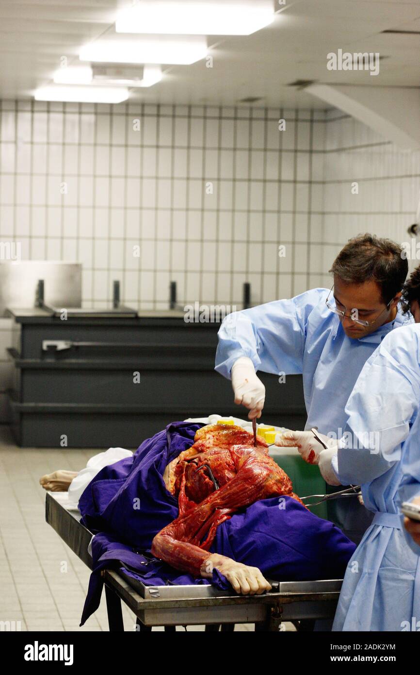 MODEL RELEASED. Autopsy examination. Pathologists dissecting a corpse ...