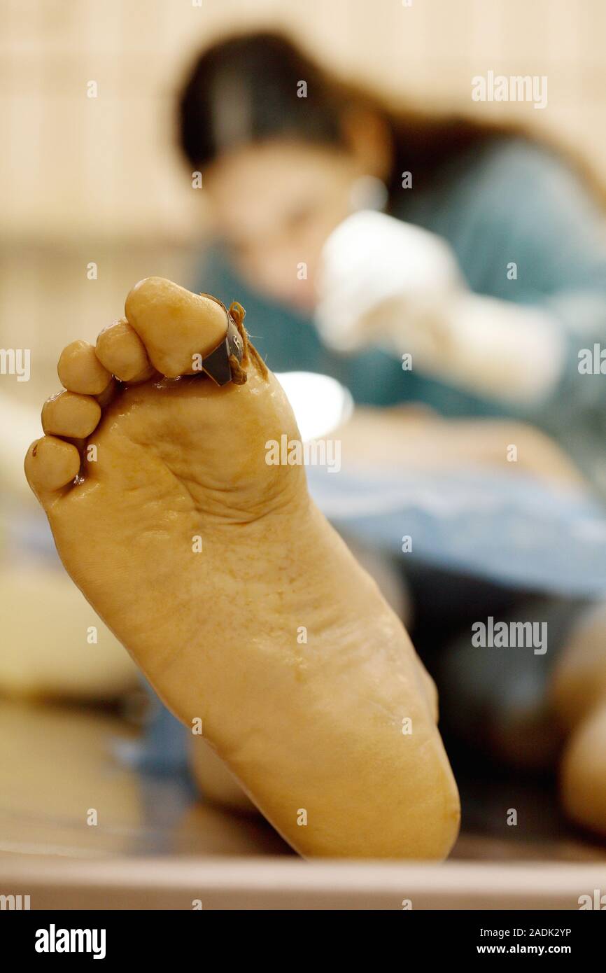 Autopsy examination. Pathologist dissecting a corpse during an autopsy ...