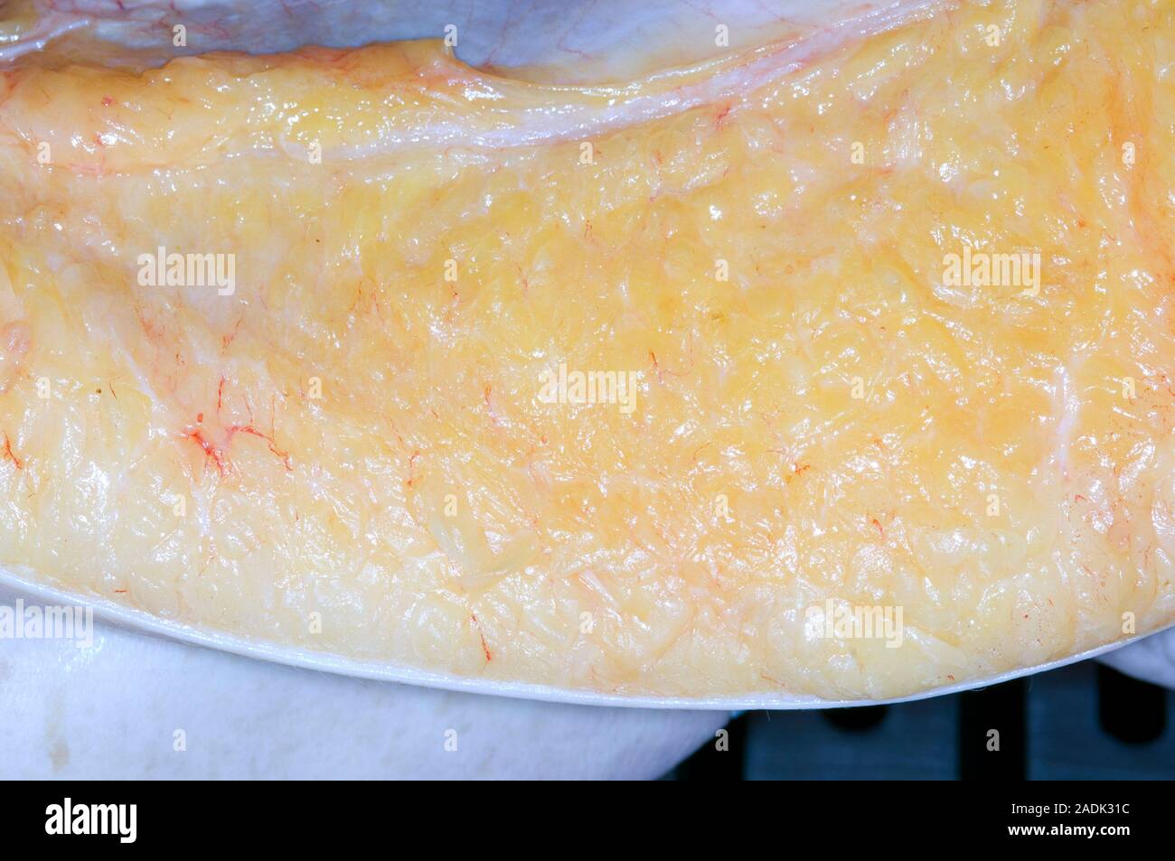 Abdominal fat, post-mortem. Adipose tissue (yellow) taken from the ...