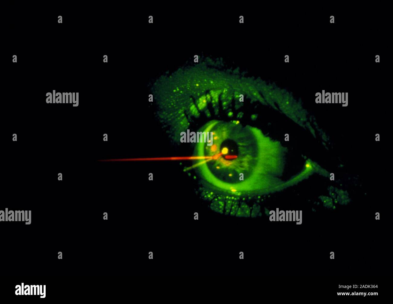 Laser surgery. A single laser beam is aimed at the cornea of the human ...