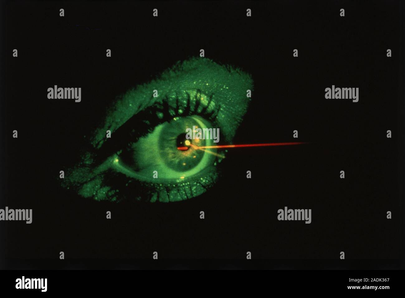 Laser eye surgery. A fine red beam of a helium- neon laser passes ...