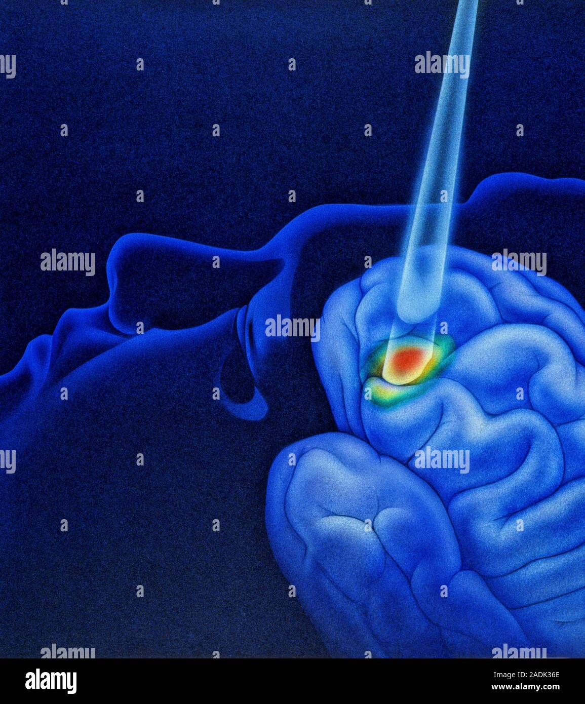 Laser treatment for brain tumour. Illustration showing a laser focused ...