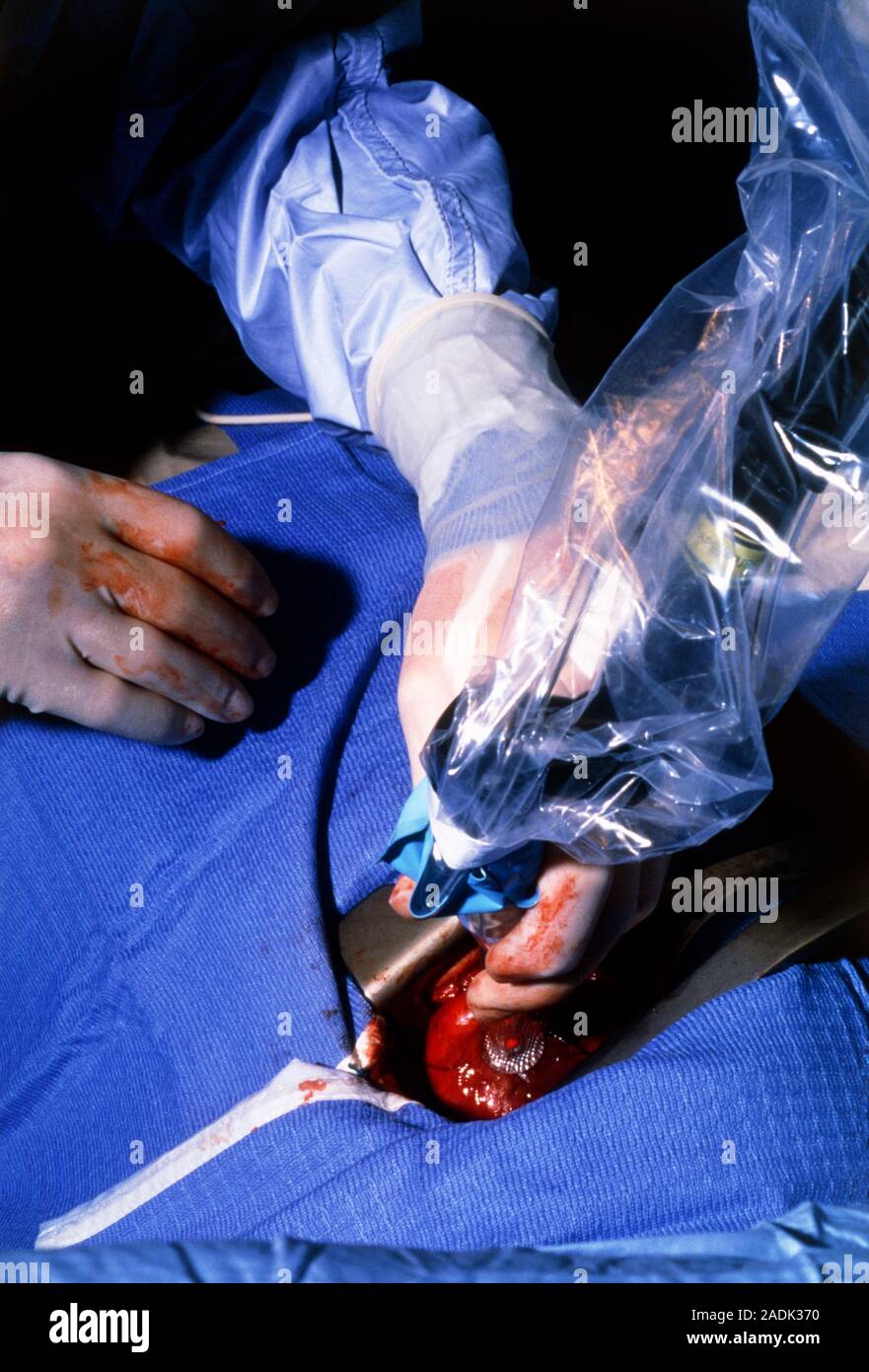 Laser heart surgery. Surgeon's gloved hand using a laser to operate ...