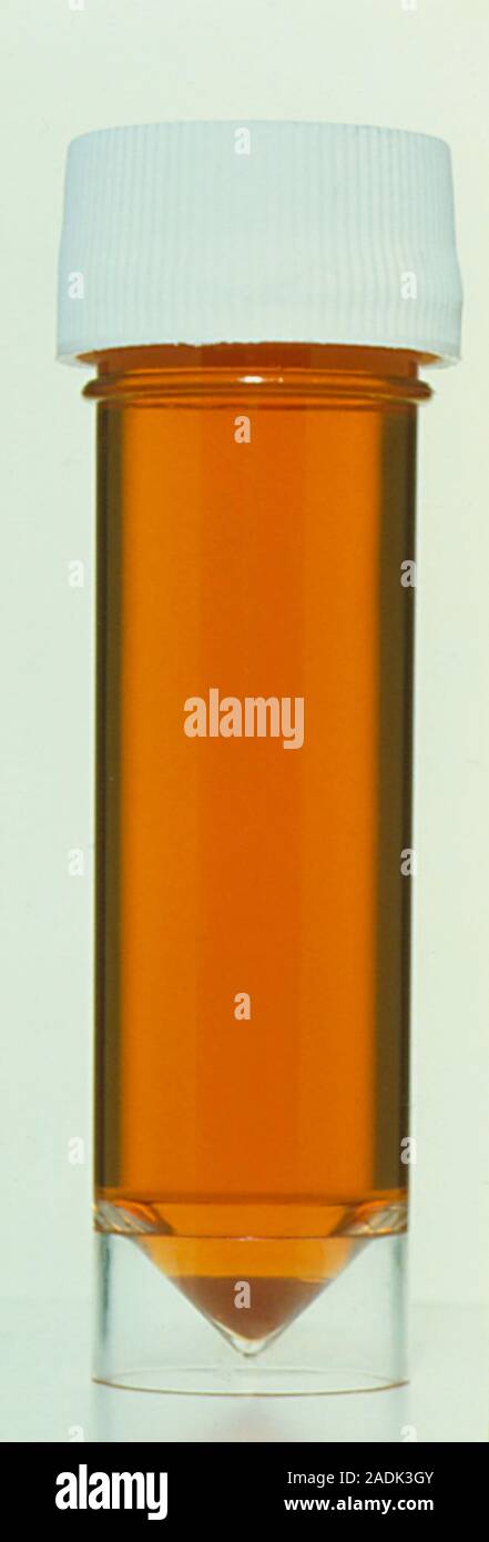 Urine sample. A sample tube from a doctor's surgery containing a ...