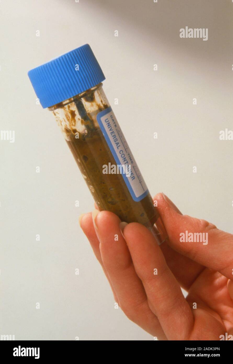 Faeces sample. Hand holding a sample tube from a general practice ...