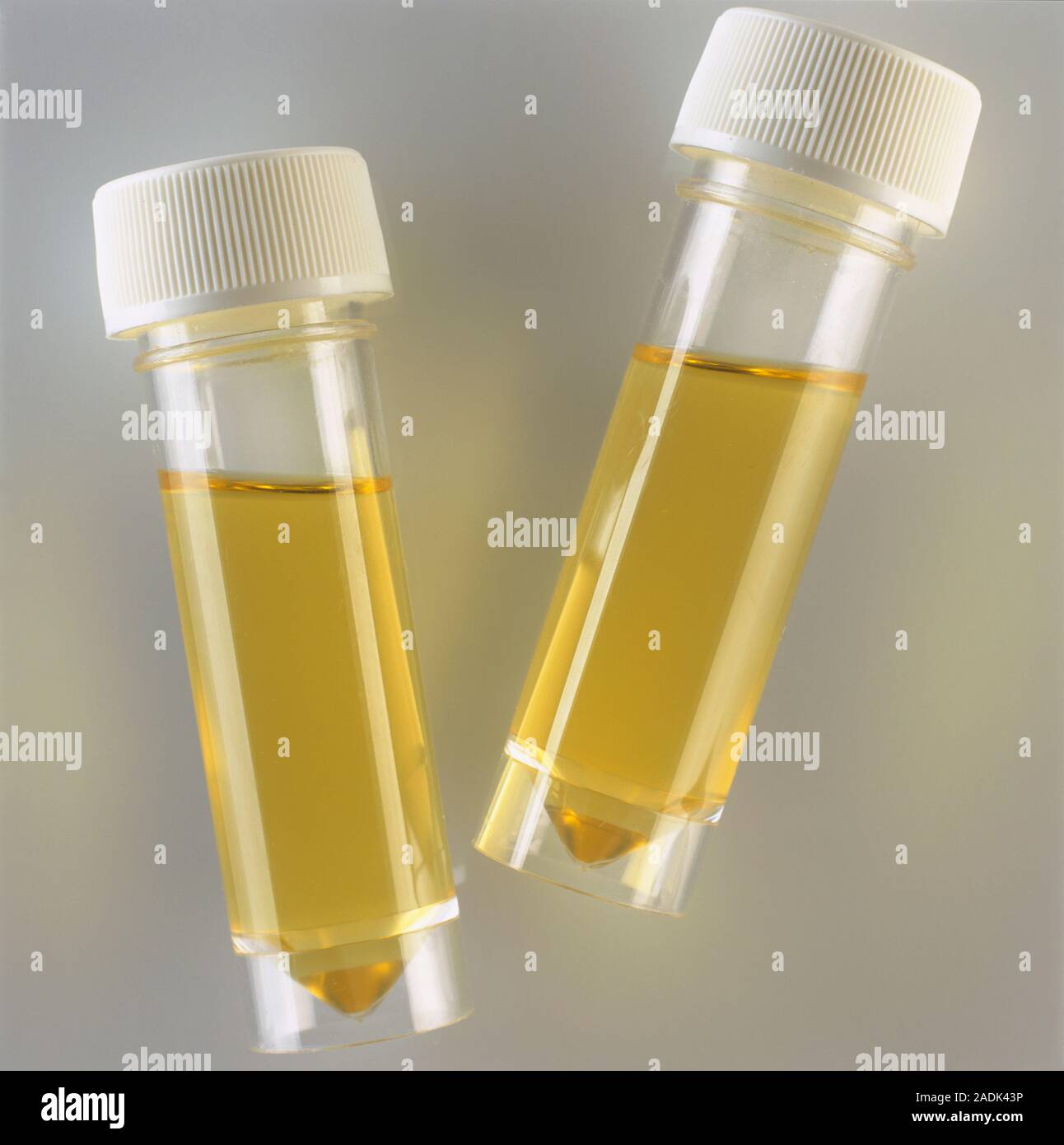 Urine samples in vials. Analysing urine can be used to diagnose ...