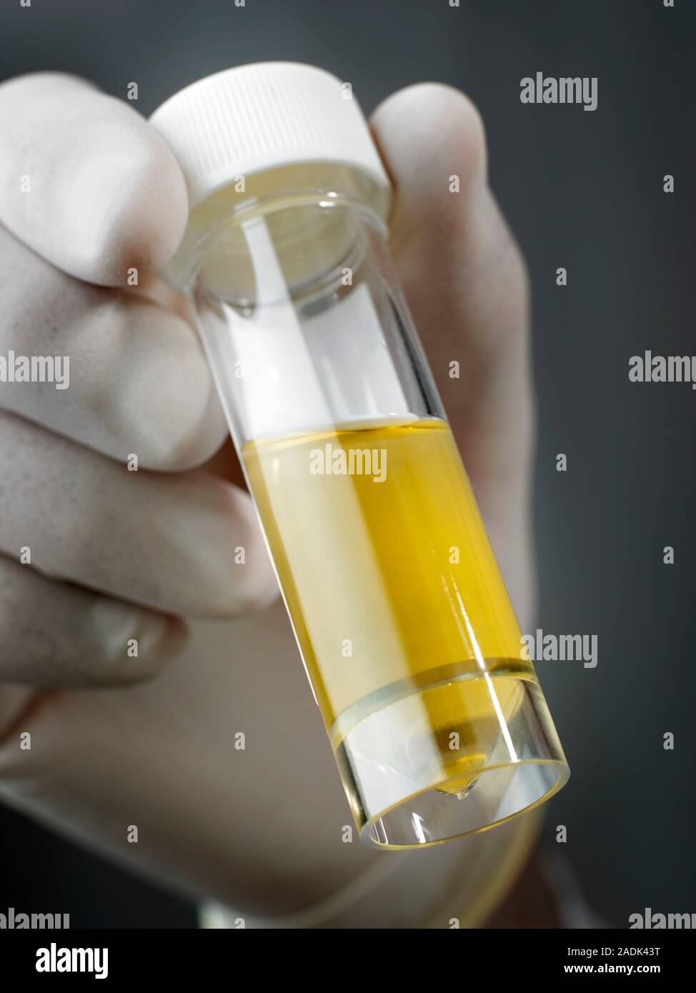 Urine sample. Laboratory technician holding a sample tube containing a ...