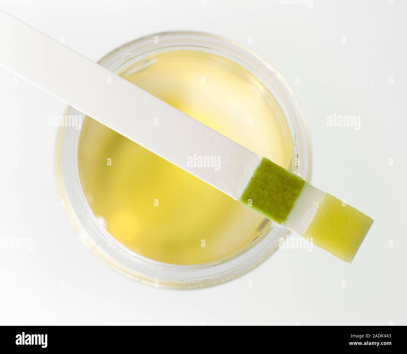 Urine analysis. Diabetes test stick (Diastix) balanced on top of a ...