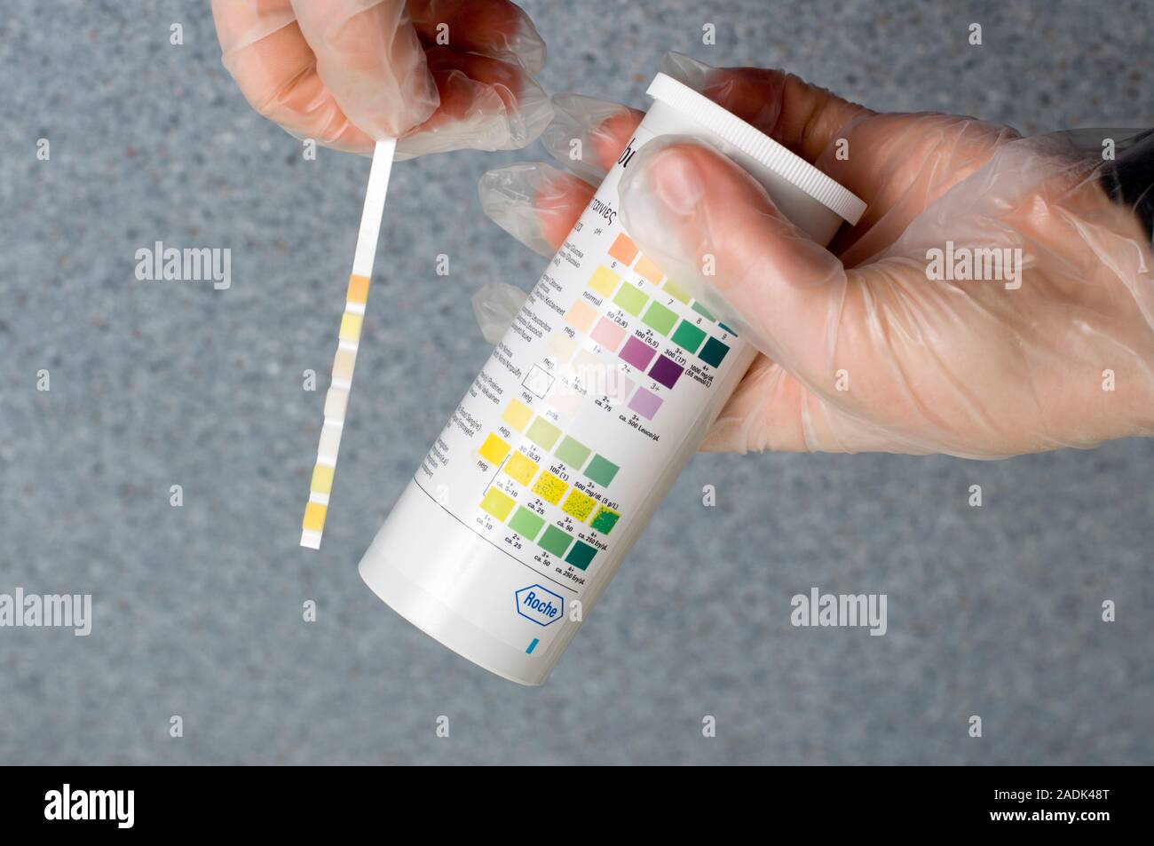MODEL RELEASED. Urine analysis. Nurse comparing urine test strip ...